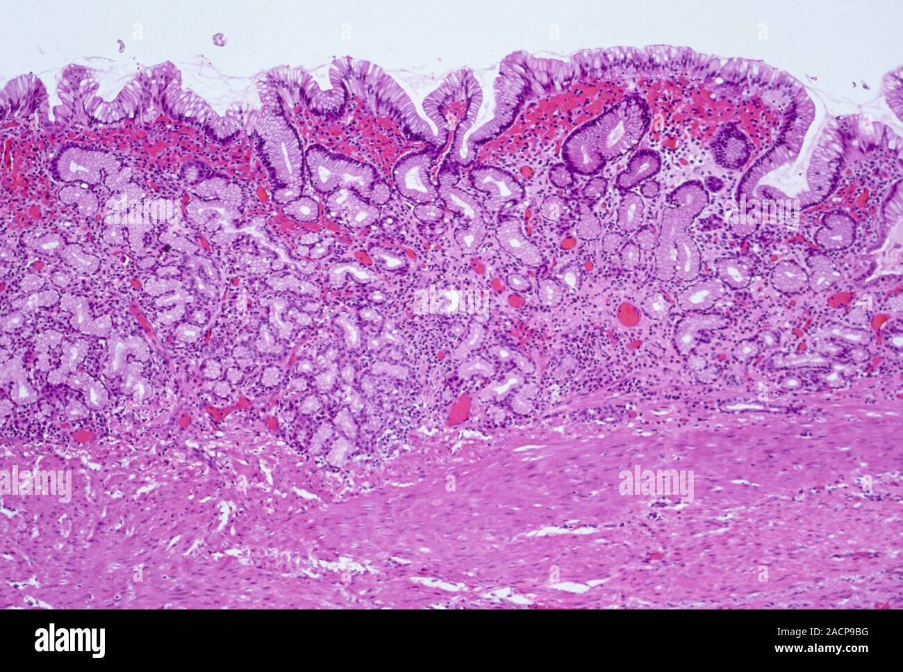 Gastritis. Light micrograph of a section through a stomach tissue ...