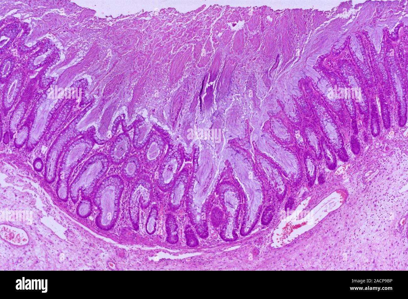 Colitis. Light micrograph of a section through colon (large intestine ...