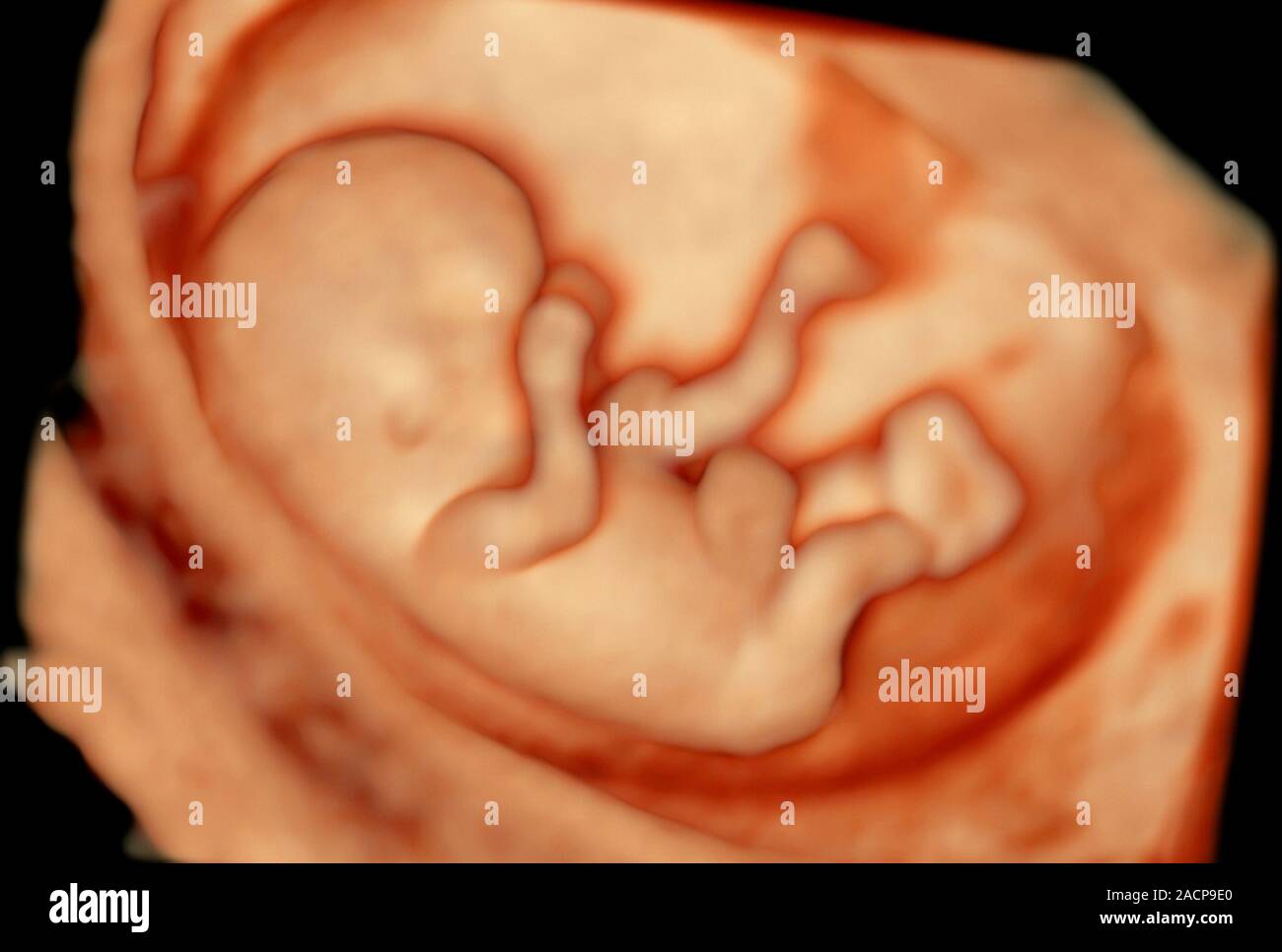 11 week foetus, 3-D ultrasound scan. Three-dimensional (3-D) ultrasound ...
