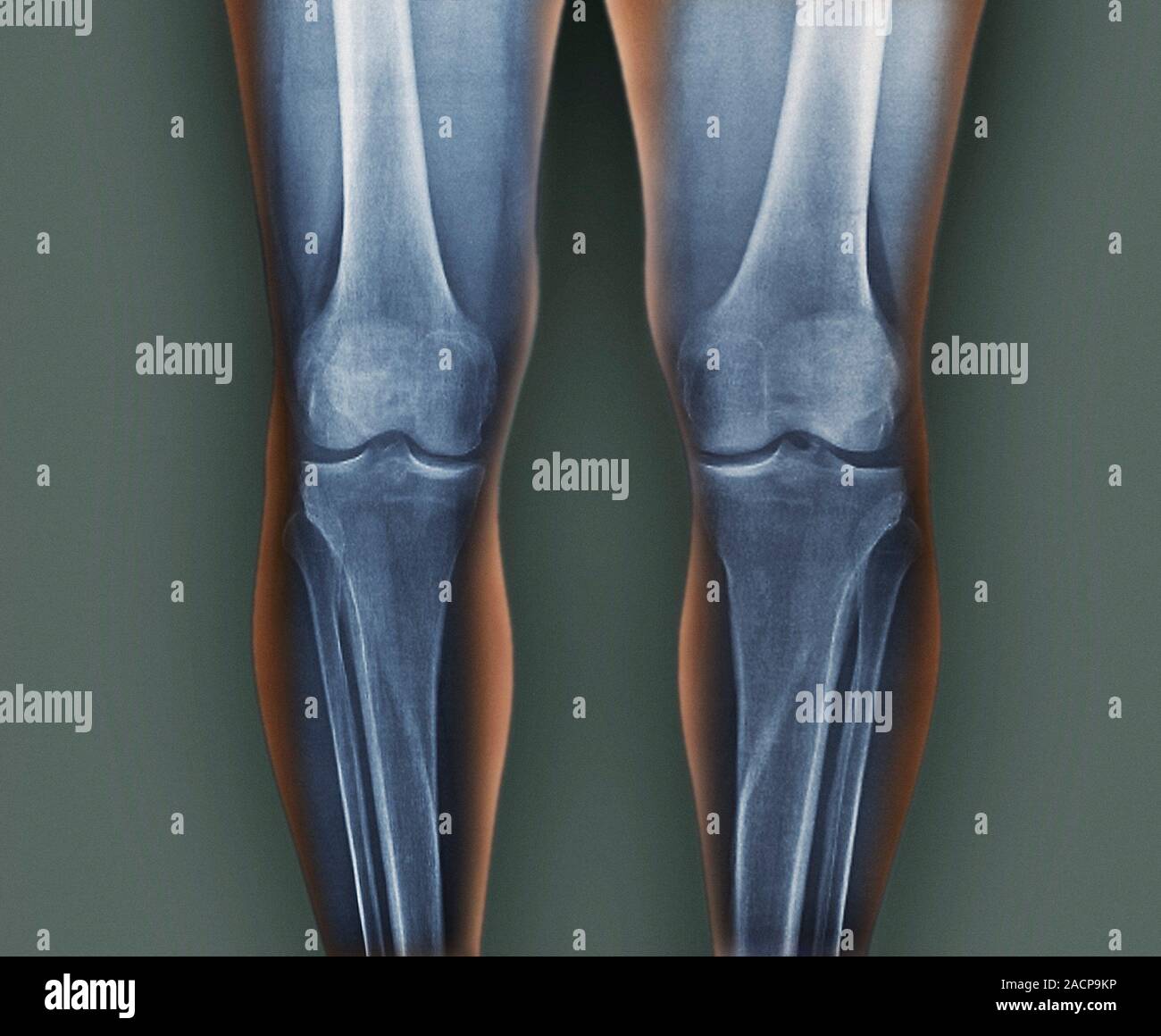 Normal knees. Coloured frontal X-rays of the healthy knees of a 35-year ...