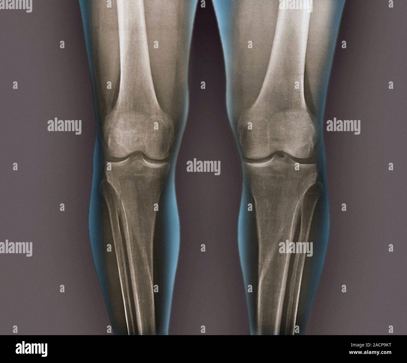 Normal knees. Coloured frontal X-rays of the healthy knees of a 35-year ...