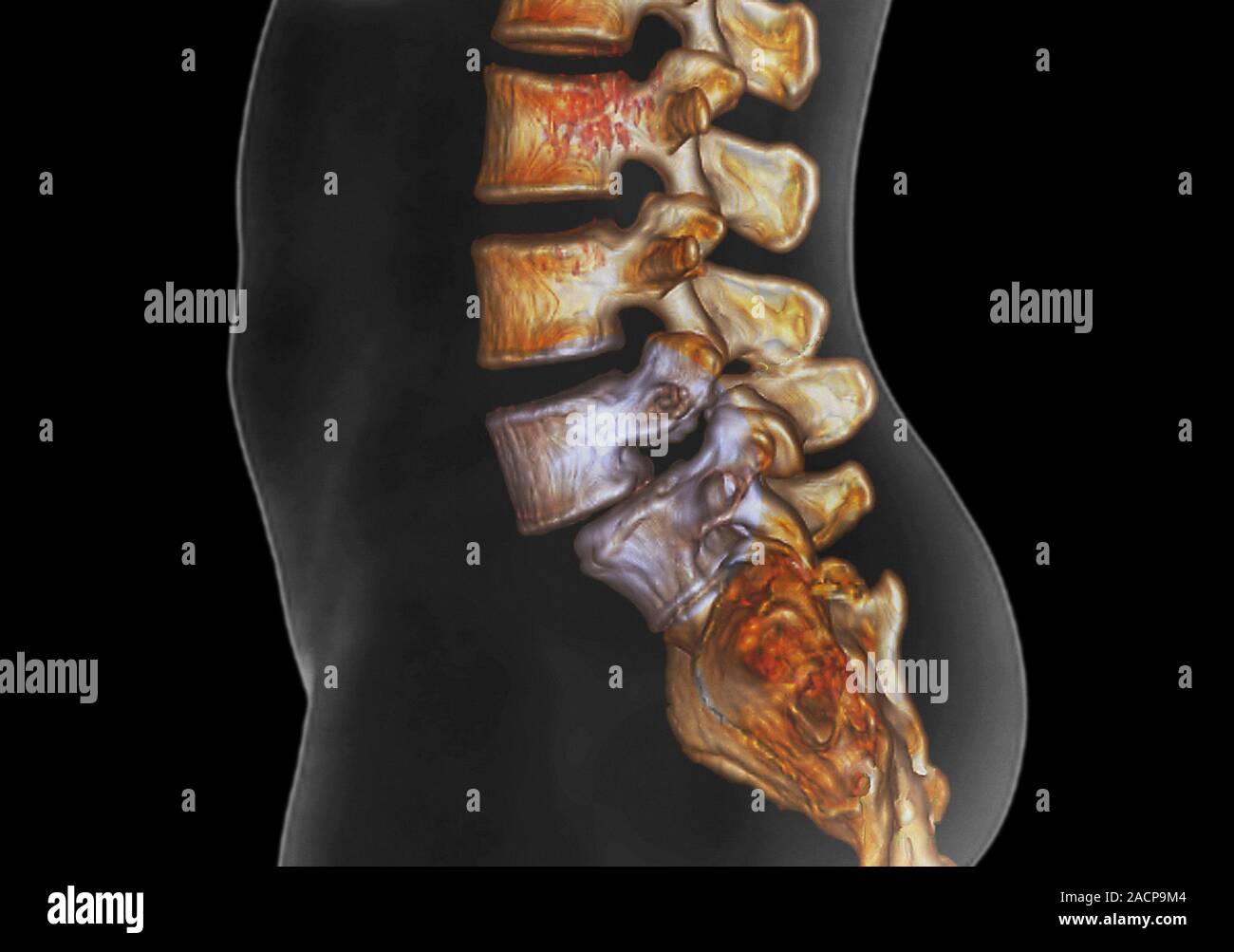 Spondylolisthesis. Coloured 3D computed tomography (CT) scan of a section through the lumbar ...