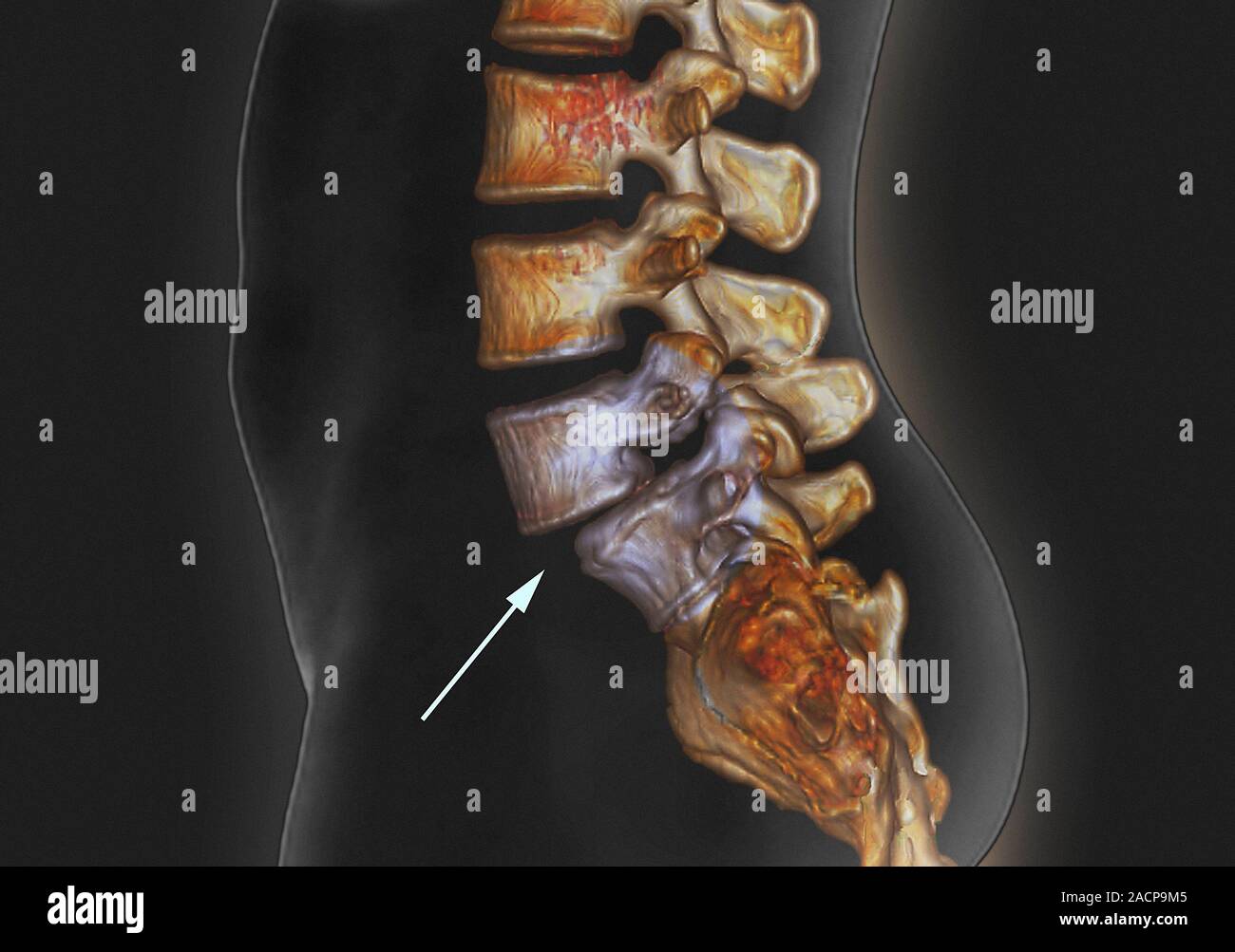 Spondylolisthesis. Coloured 3D computed tomography (CT) scan of a ...