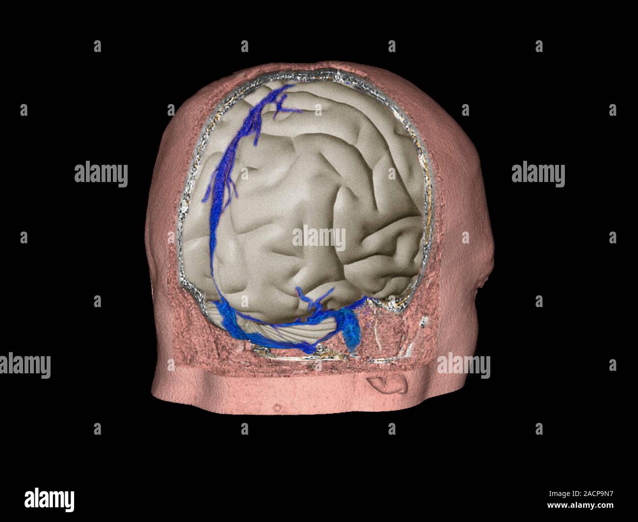 Thrombophlebitis in the brain. Coloured 3D computed tomography (CT) angiogram of the blood ...