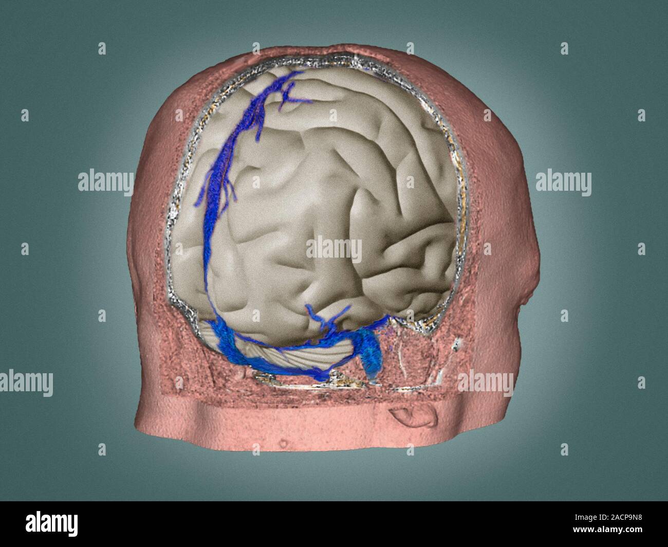 Thrombophlebitis in the brain. Coloured 3D computed tomography (CT) angiogram of the blood ...