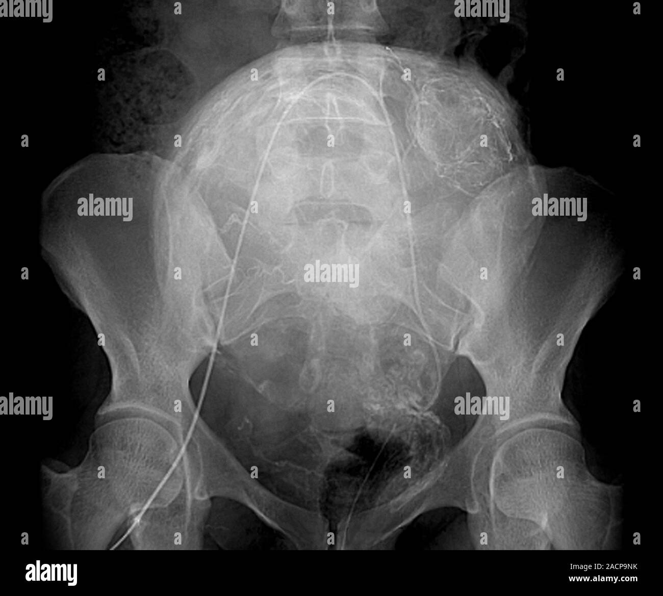 Uterine bleeding treatment. Digital subtraction angiogram (DSA) of the ...