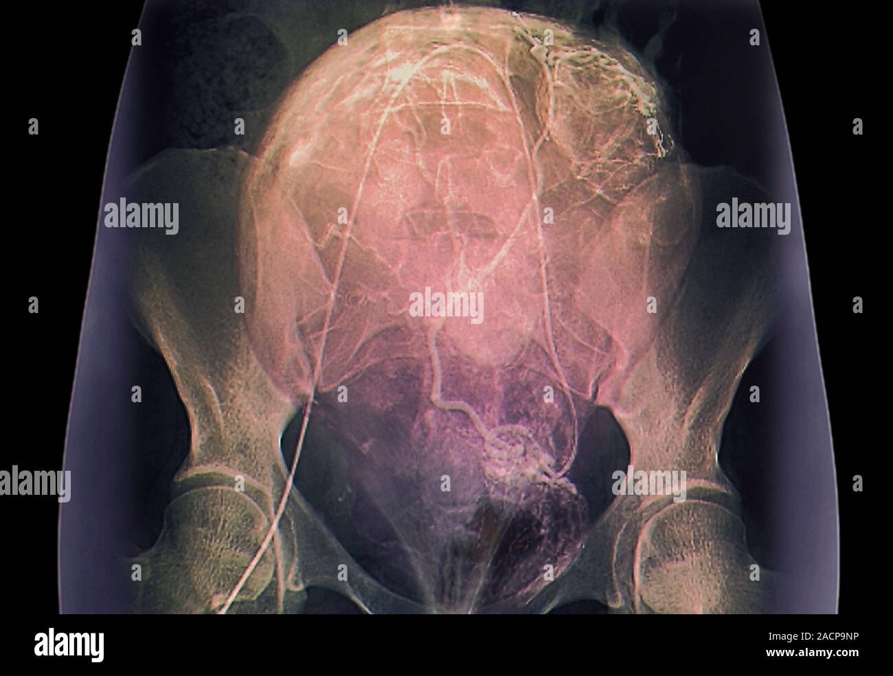 Uterine bleeding treatment. Coloured digital subtraction angiogram (DSA ...