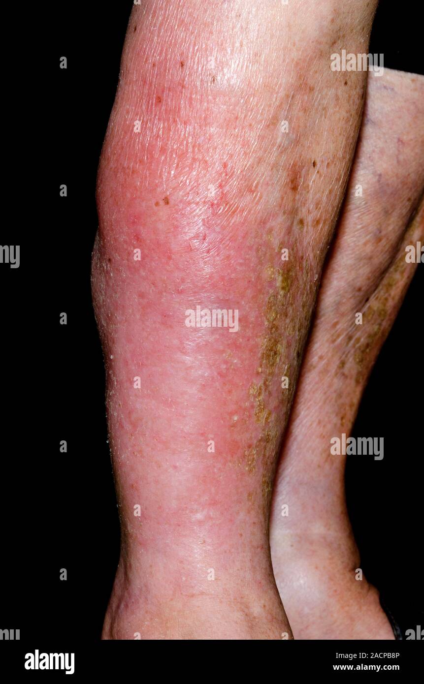 Red and inflamed skin on the leg in an 84 year old female patient due ...