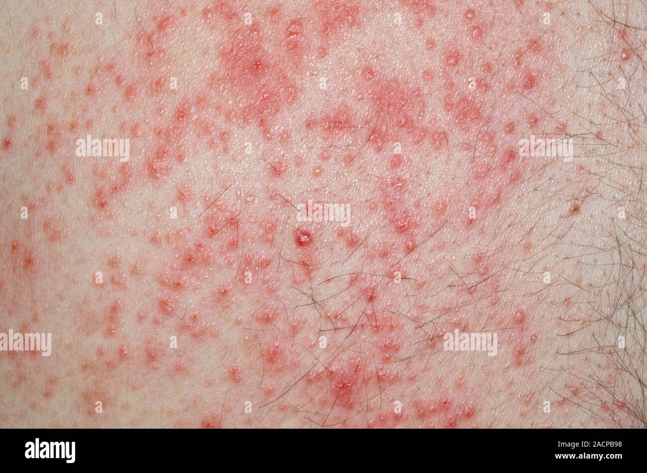 Close-up of a red rash on the skin of the back in a 30 year old male ...