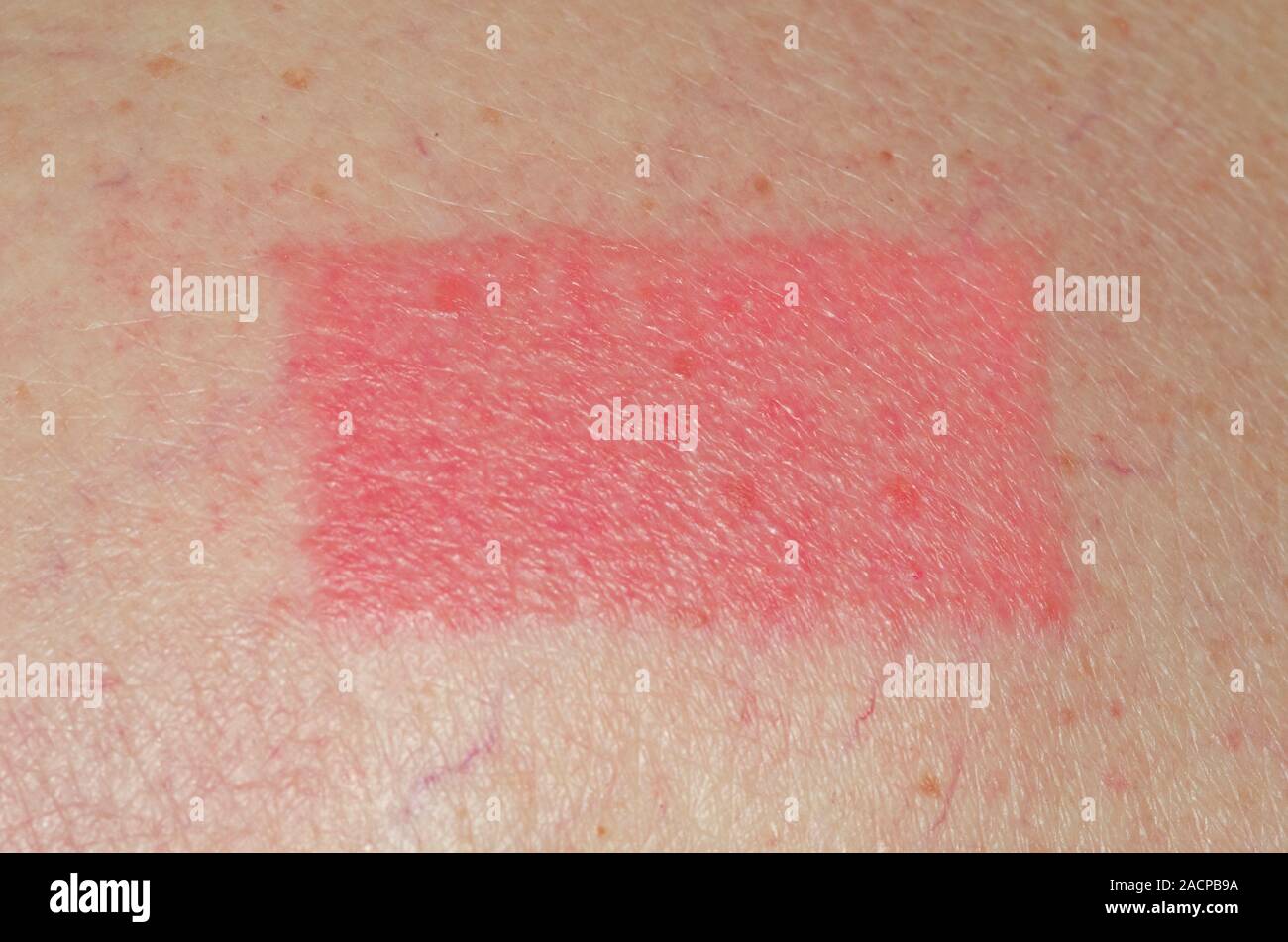 Close-up of a red rash on the skin in an 88 year old female patient due ...