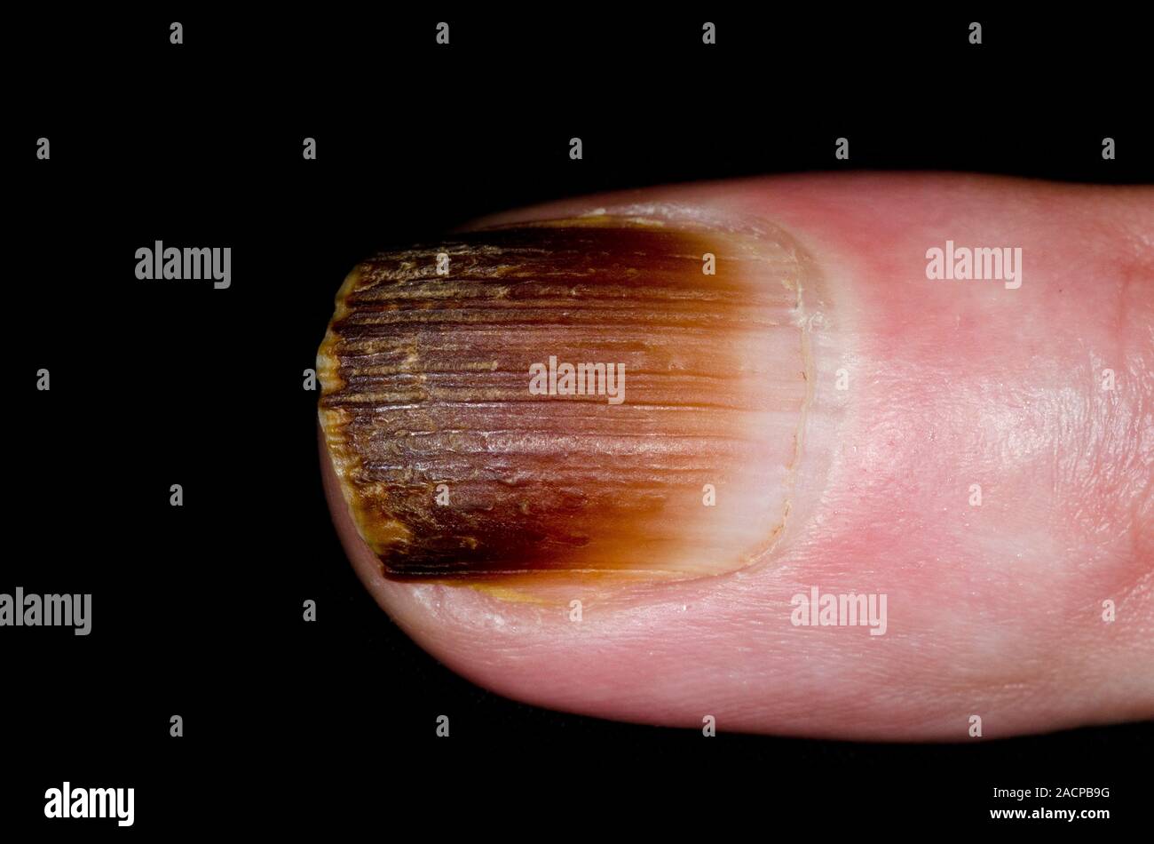 Close-up of the darkened fingernail in a 72 year old male patient with ...