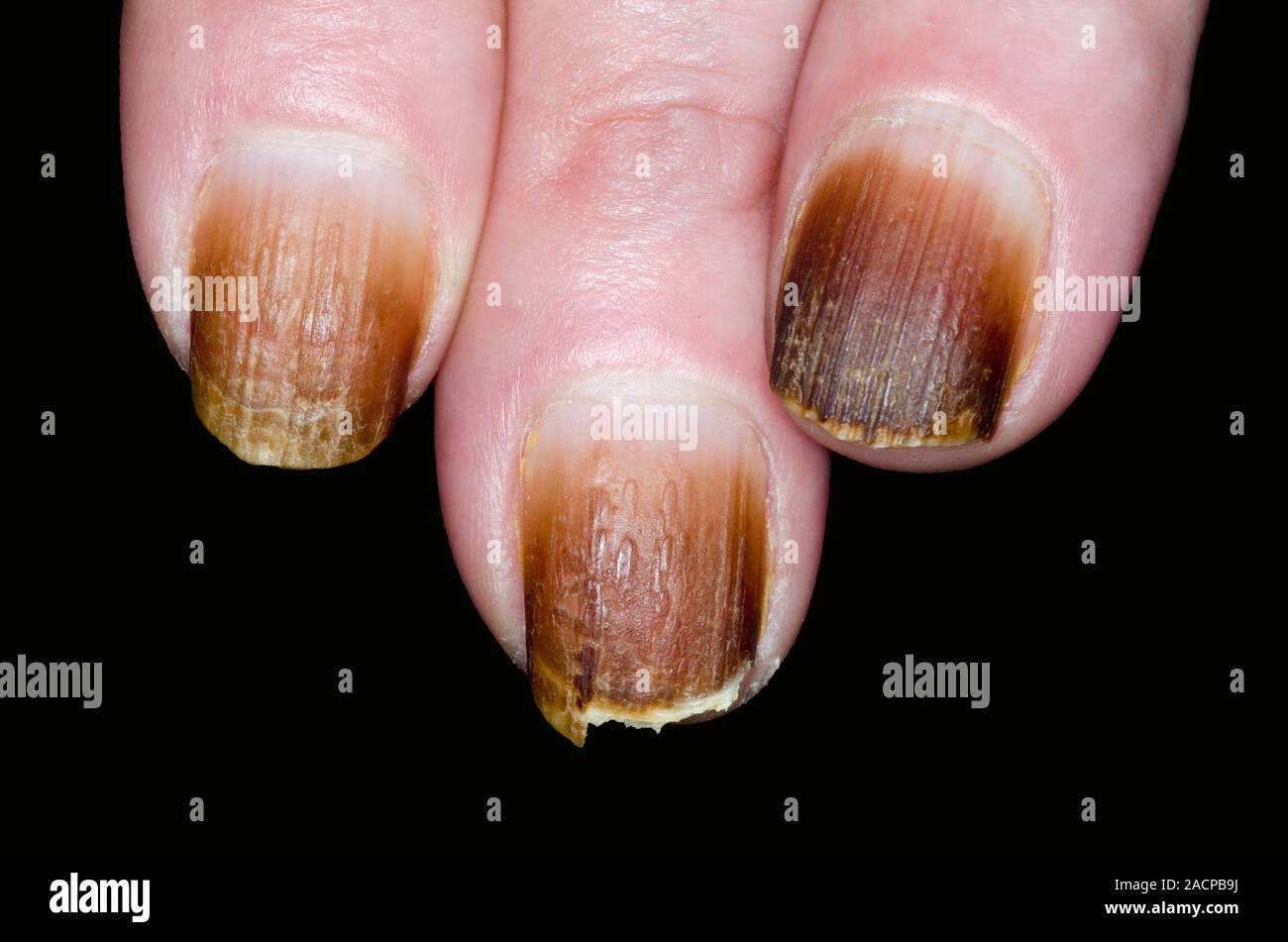 Close-up of the darkened fingernails in a 72 year old male patient with ...