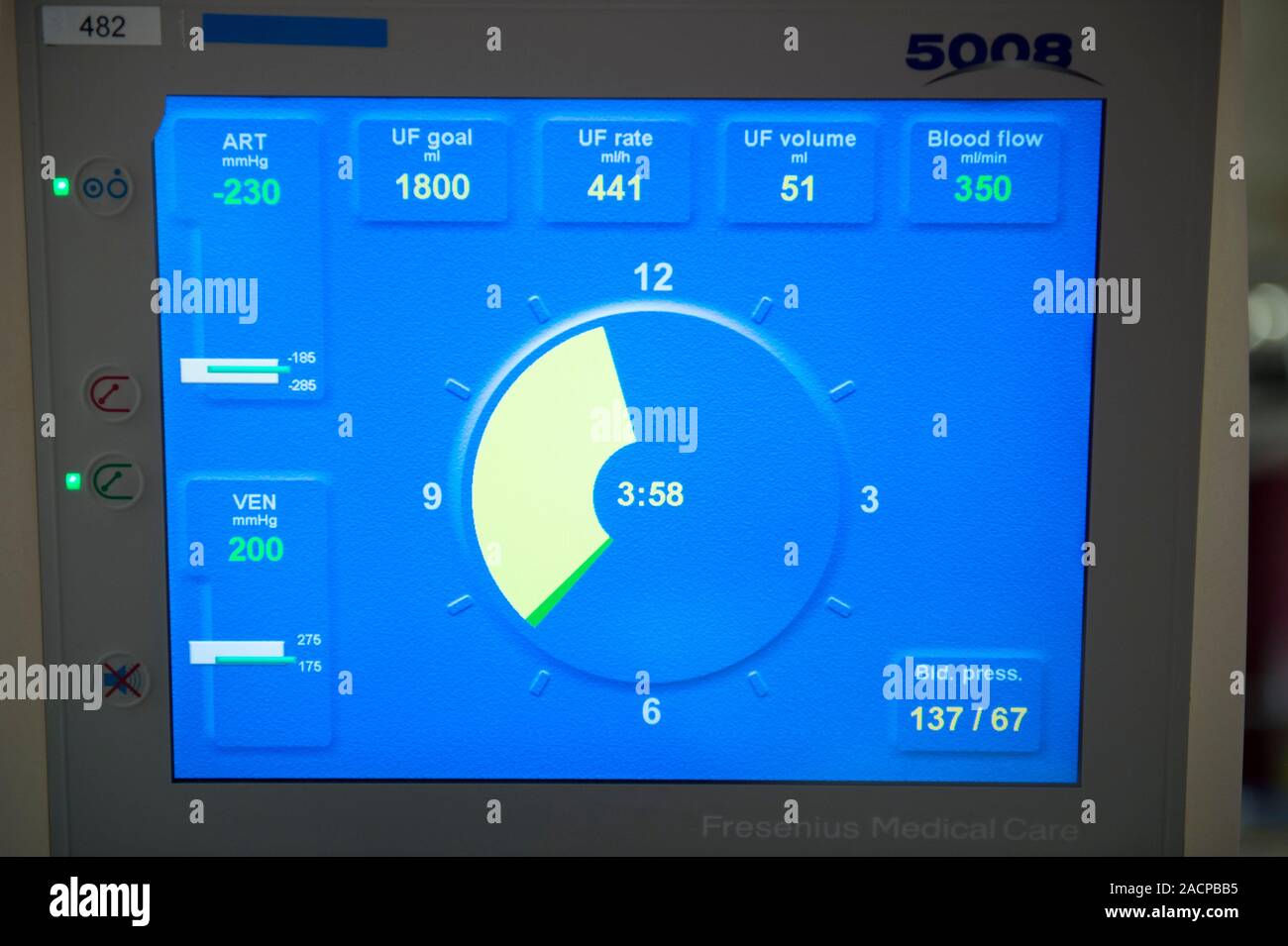 Screen monitor of a kidney dialysis (haemodialysis) machine showing the ...