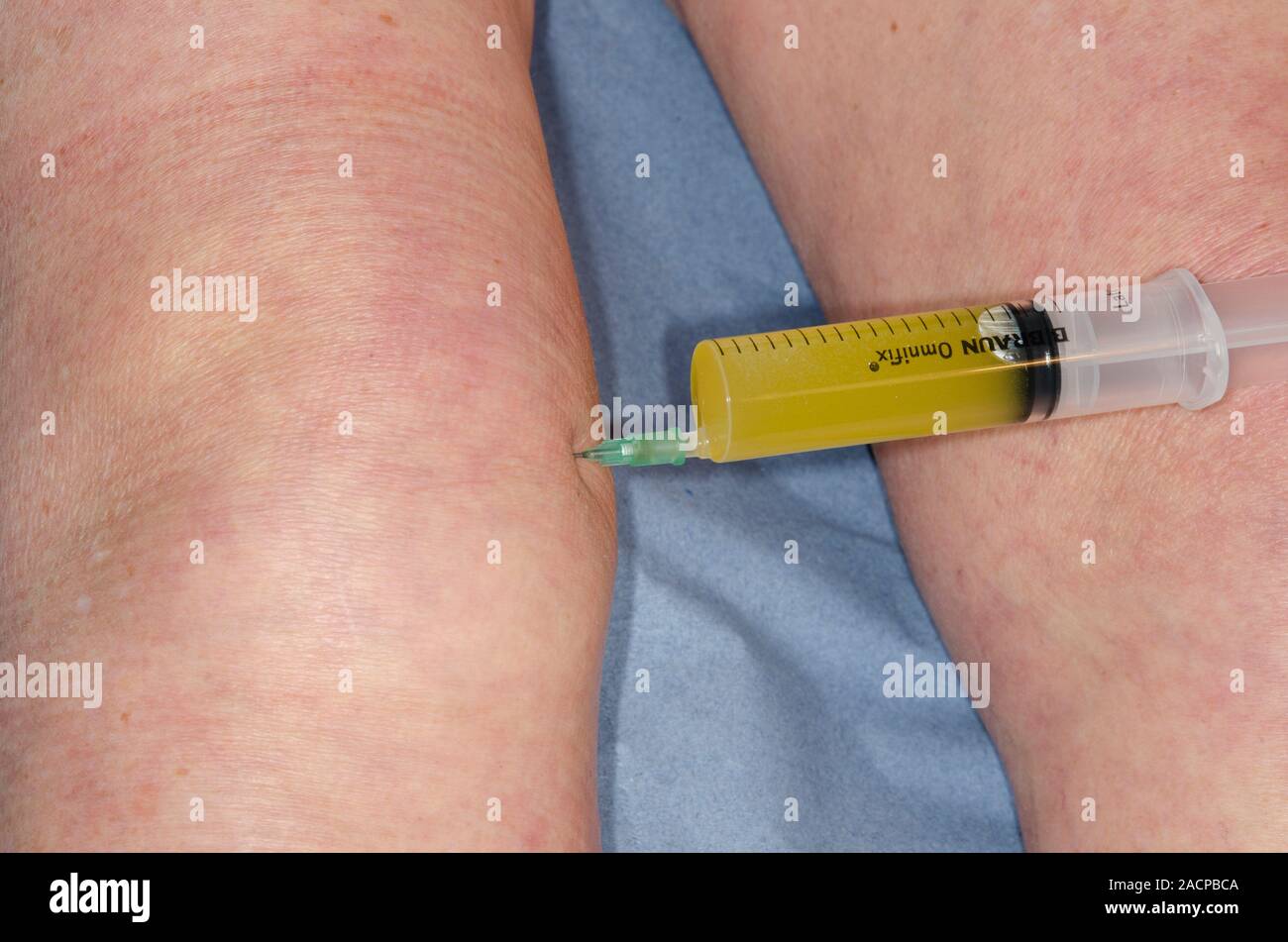 Syringe used to extract fluid from the knee in a 59 year old female ...
