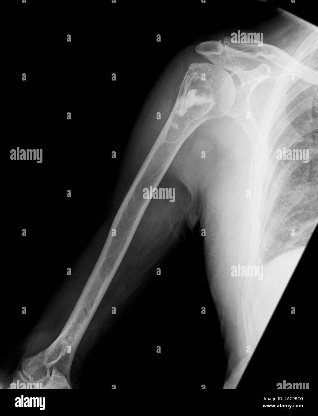 Bone death. X-ray (front view) of the upper arm (humerus bone) in 79 ...