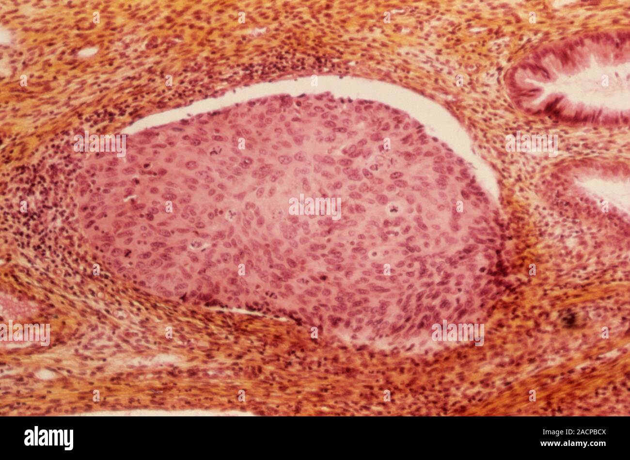Cervical cancer. Light micrograph of a section through tissue from the ...