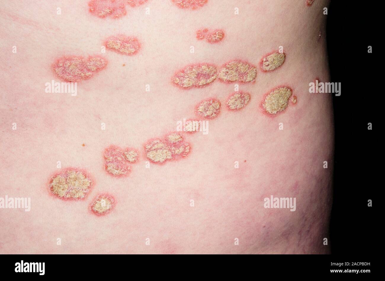 Red plaques (patches) of psoriasis on the skin in a 35 year old male ...