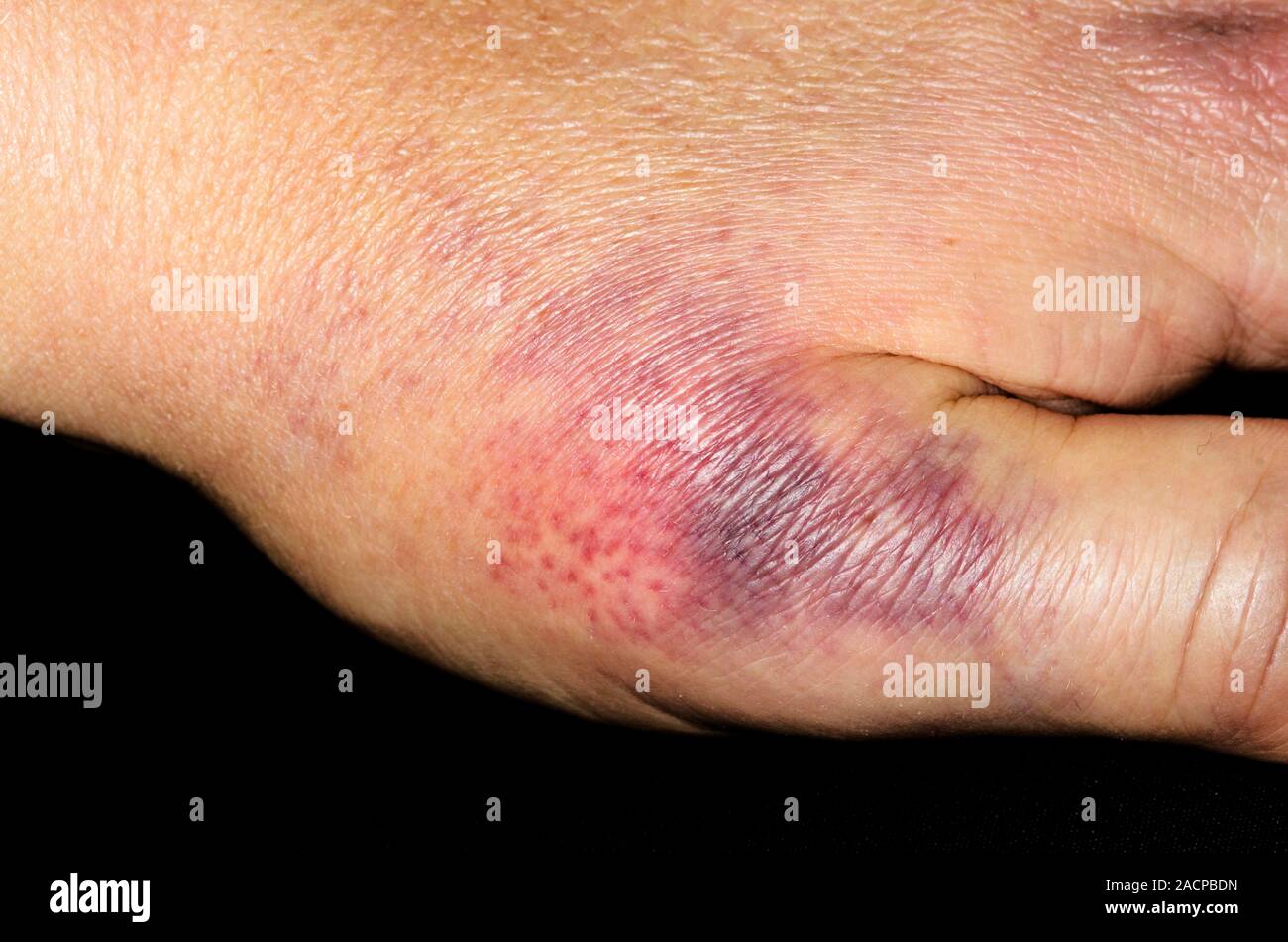 Bruising around the base of the thumb in a 46 year old female patient ...