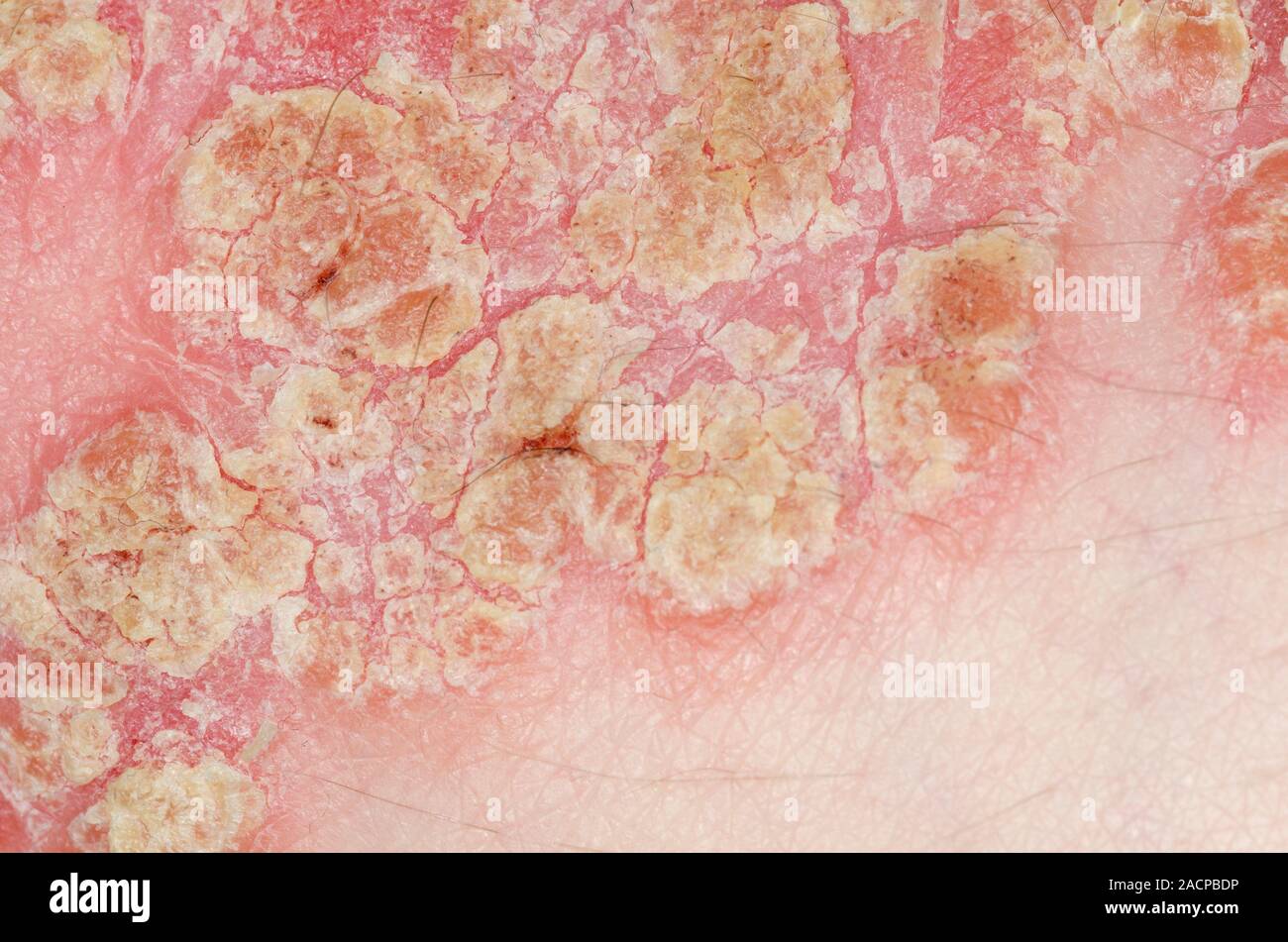 Close-up of red plaques (patches) of psoriasis on the skin in a 35 year ...