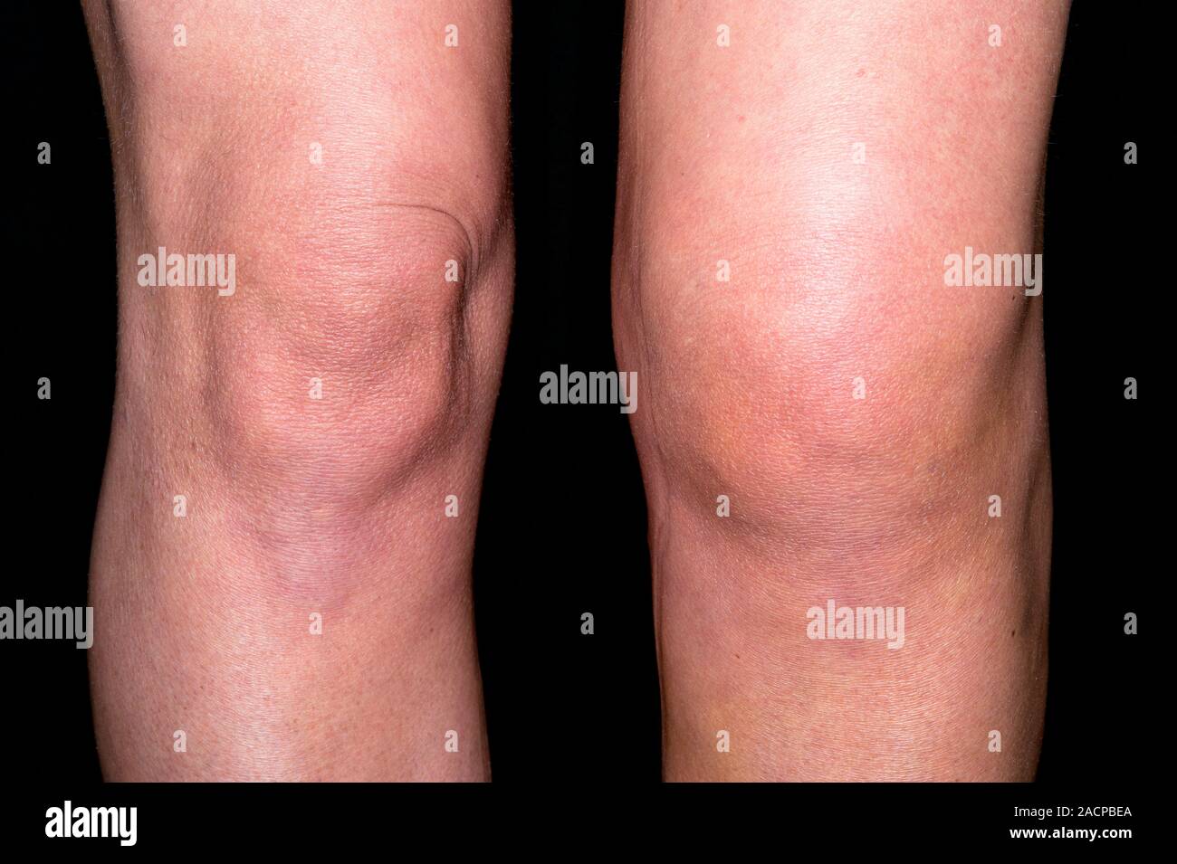 Swollen knee (at right) in a 44 year old female patient with a ruptured ...