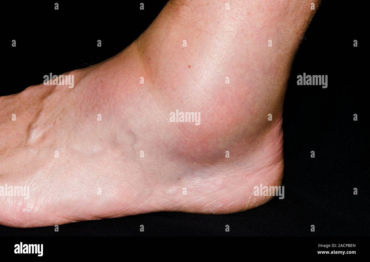 Red and swollen sprained (twisted) ankle in a 50 year old male patient ...