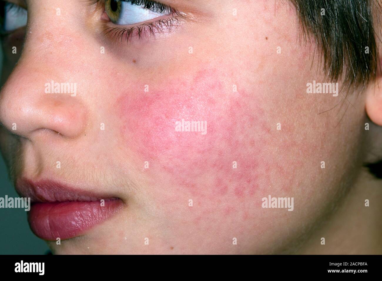 Red cheek in an 8 year old male patient with Fifth disease (slapped ...