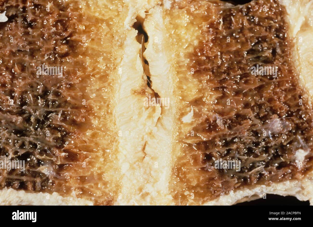 Backbone fat deposition. Sectioned gross clinical specimen of a ...