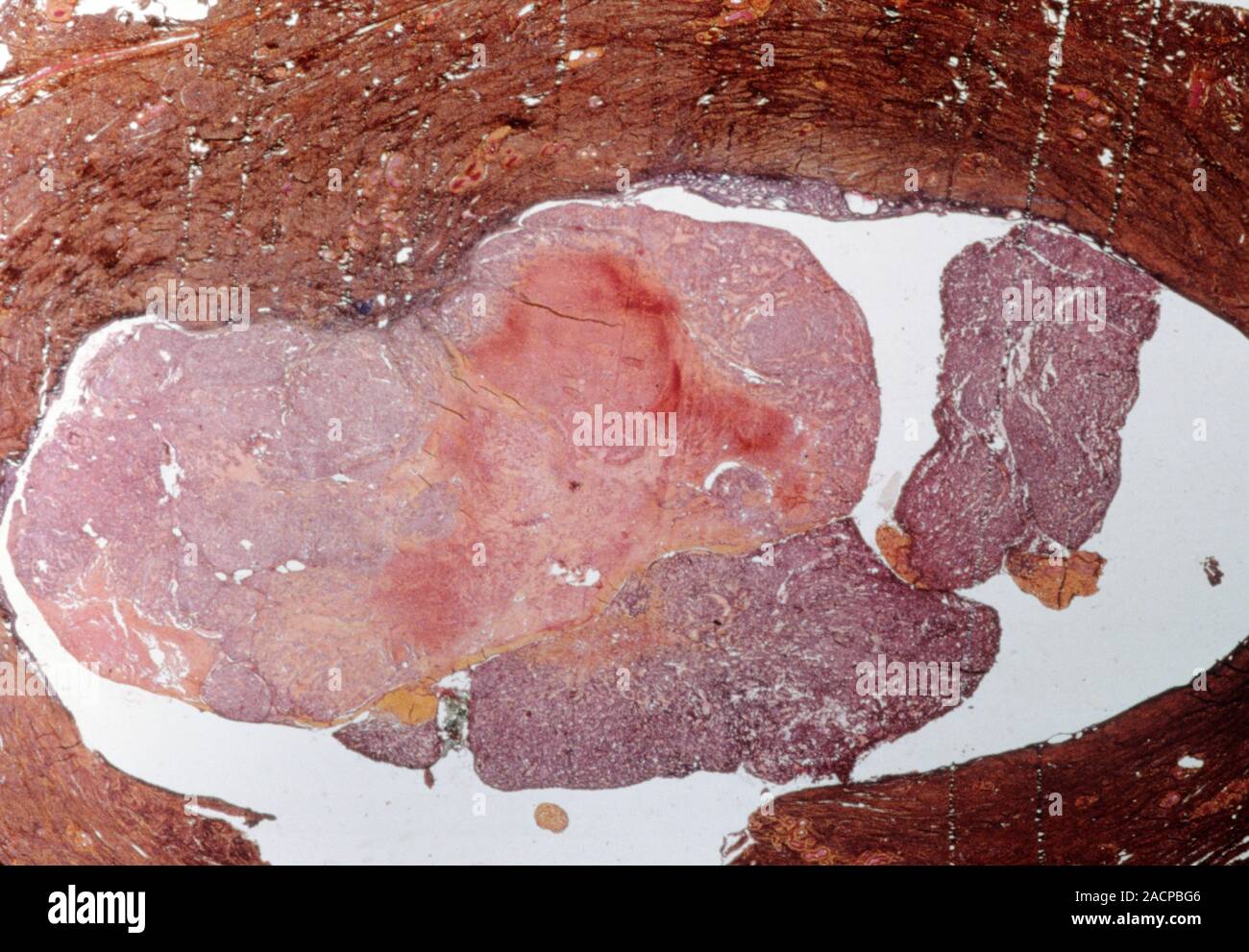 Endometrial cancer. Light micrograph of a section through a tumour in ...