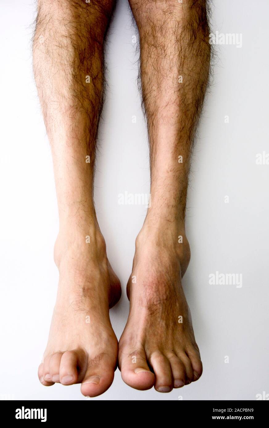 Not for use in Television Not for use in Television Muscle wasting of ...