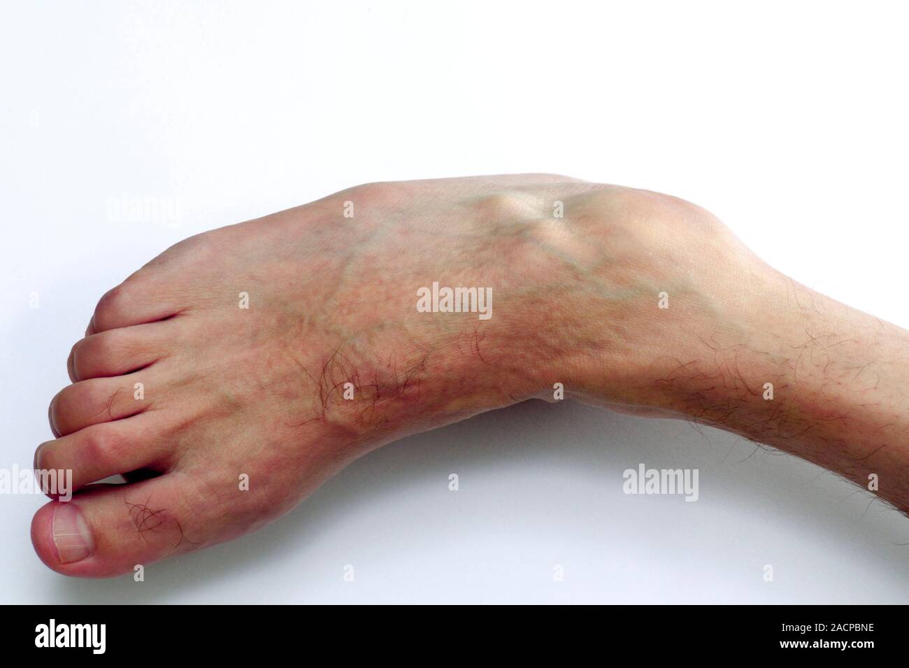 Not for use in Television Not for use in Television Club foot (talipes ...