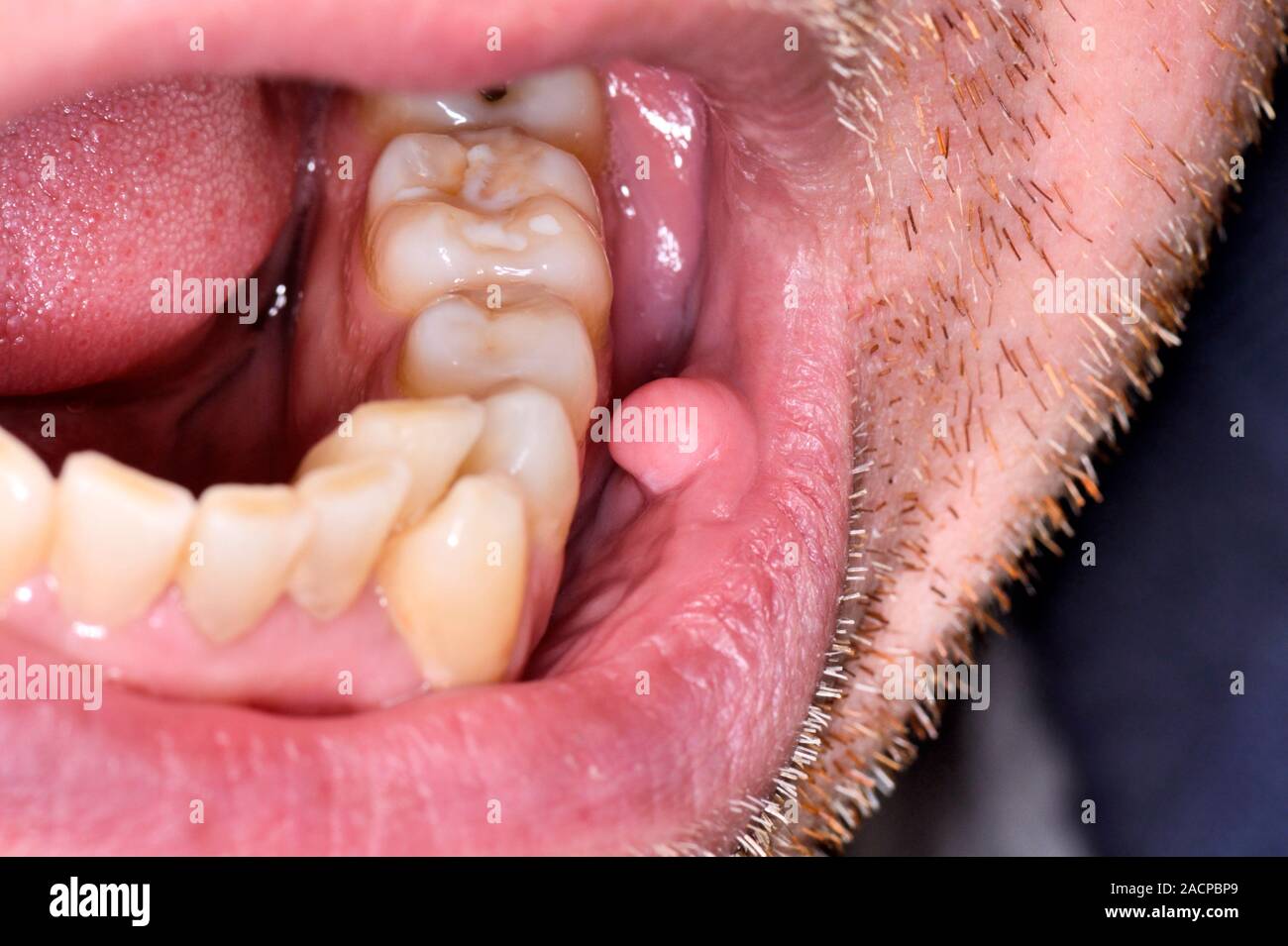 Not for use in Television Not for use in Television Fibroma on the ...