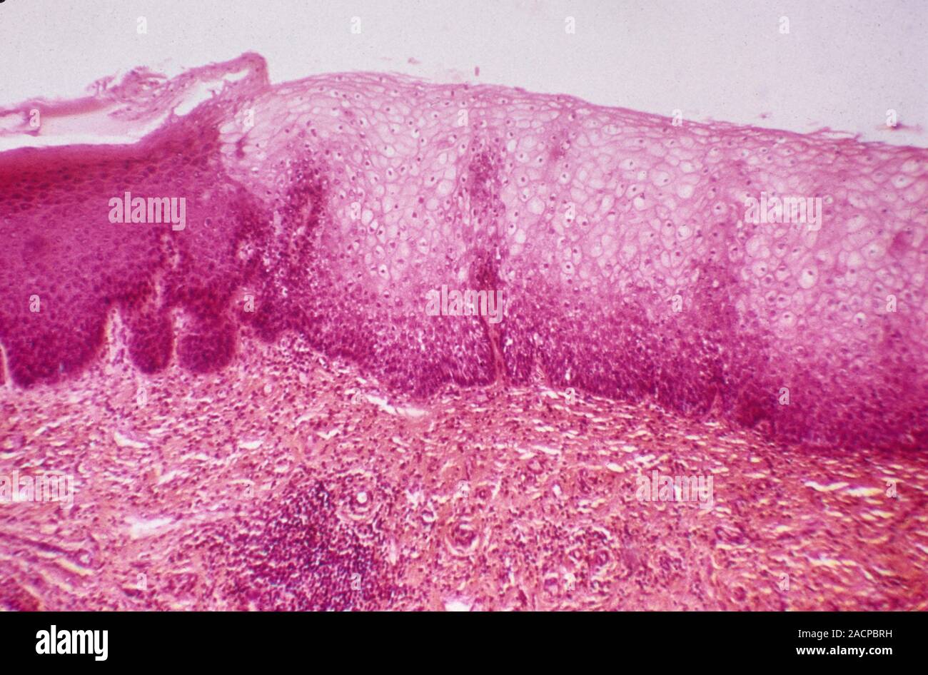 Cervical thickening. Light micrograph of a section through the ...