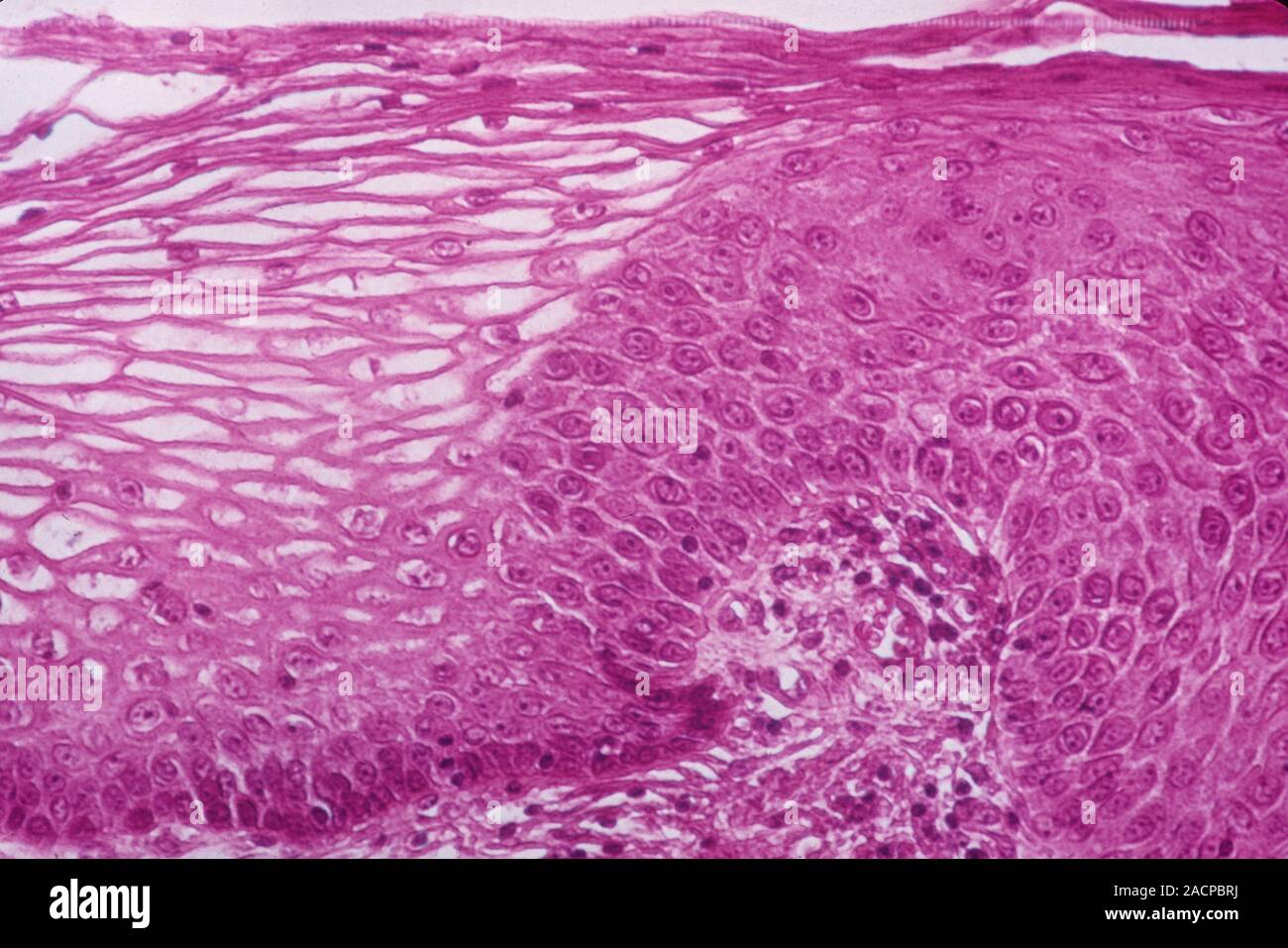 Cervical thickening. Light micrograph of a section through the ...
