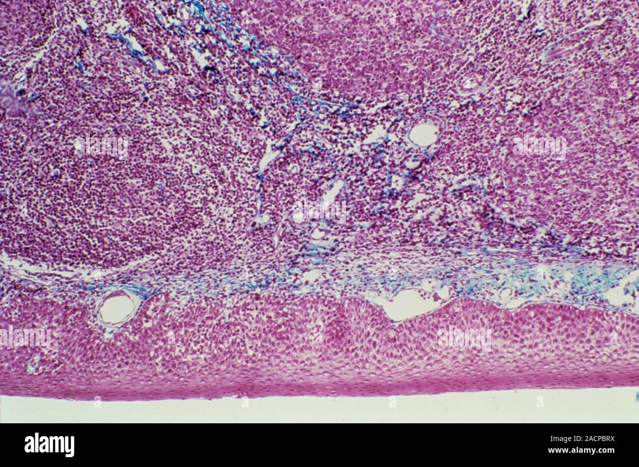 Palatine tonsil. Light micrograph of a section through the surface of a ...