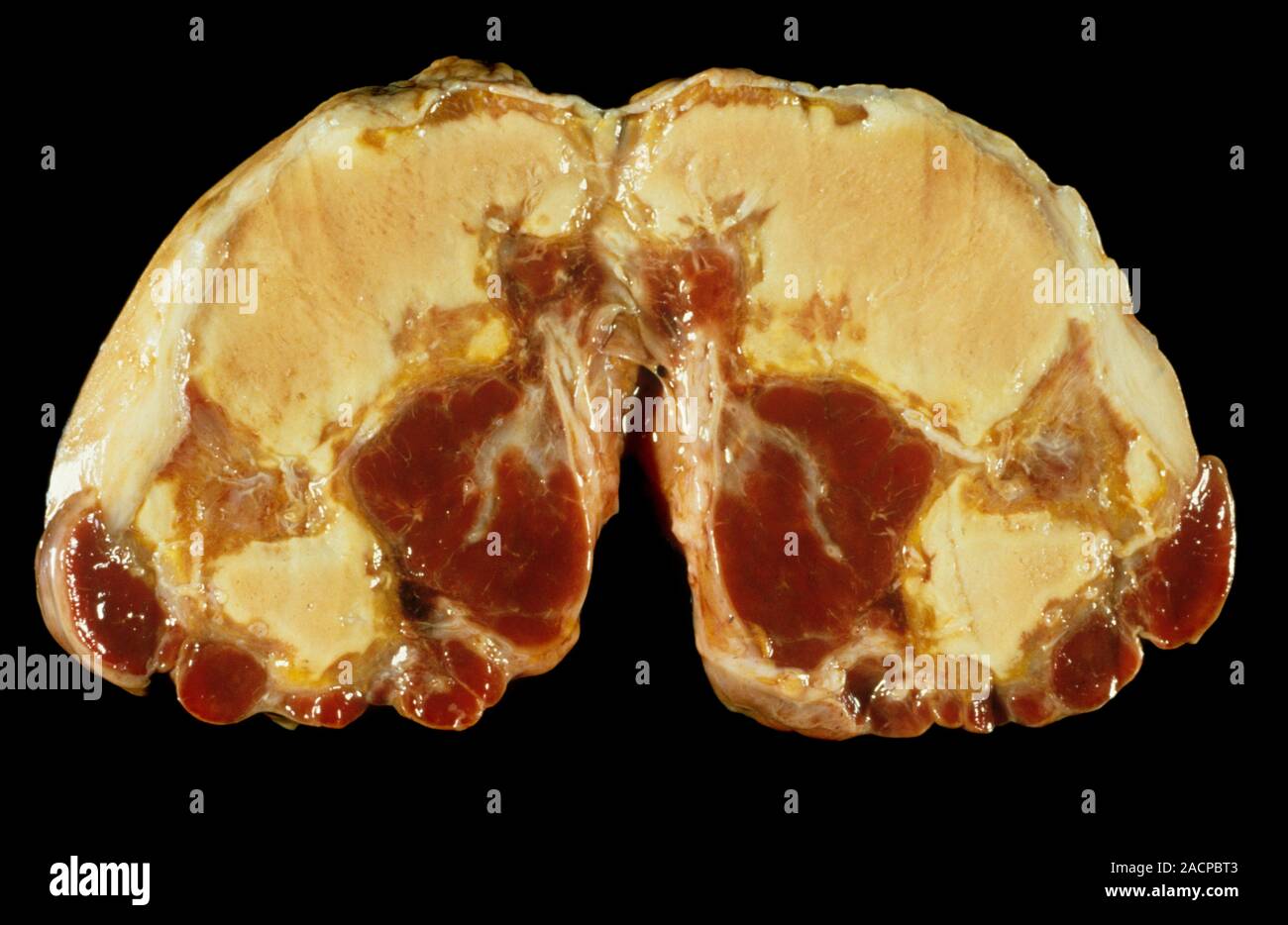 Splenic infarct. Gross specimen of a sectioned spleen showing areas of ...