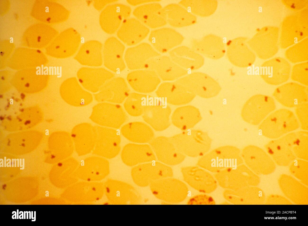 Heinz bodies. Light micrograph showing Heinz bodies (red), inclusion of ...