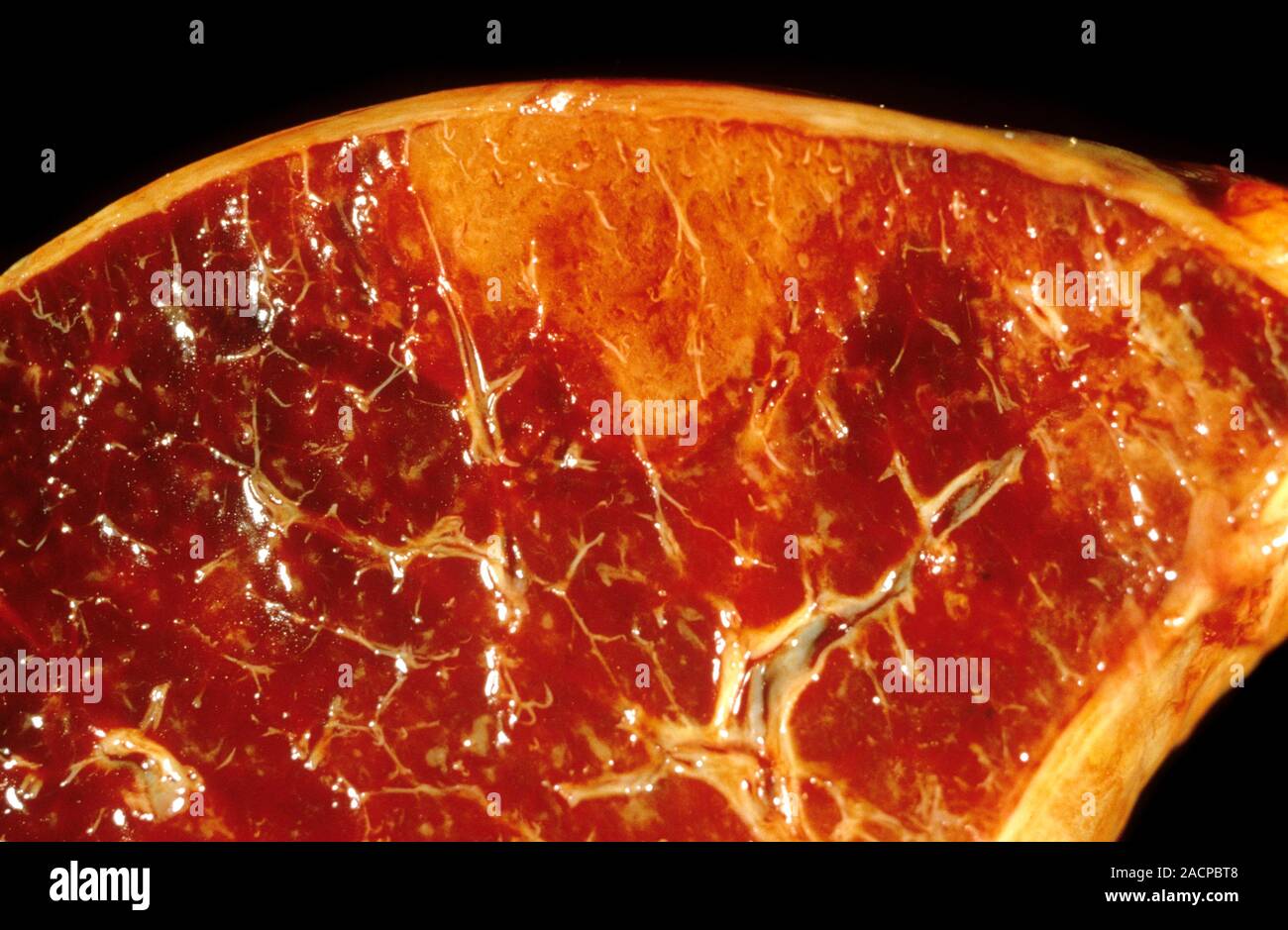 Splenic infarct. Gross specimen of a sectioned spleen showing areas of ...