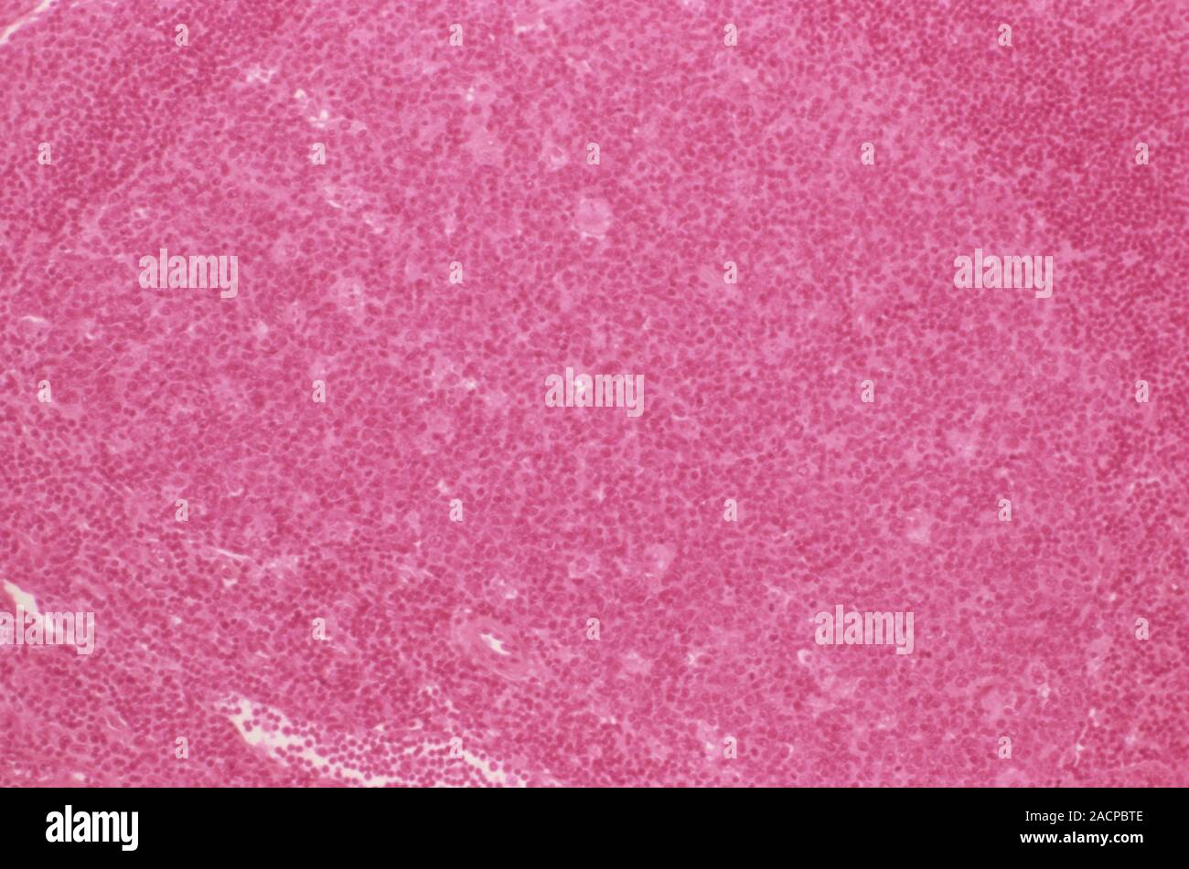 Lymph node hyperplasia. Light micrograph of a section through a lymph ...