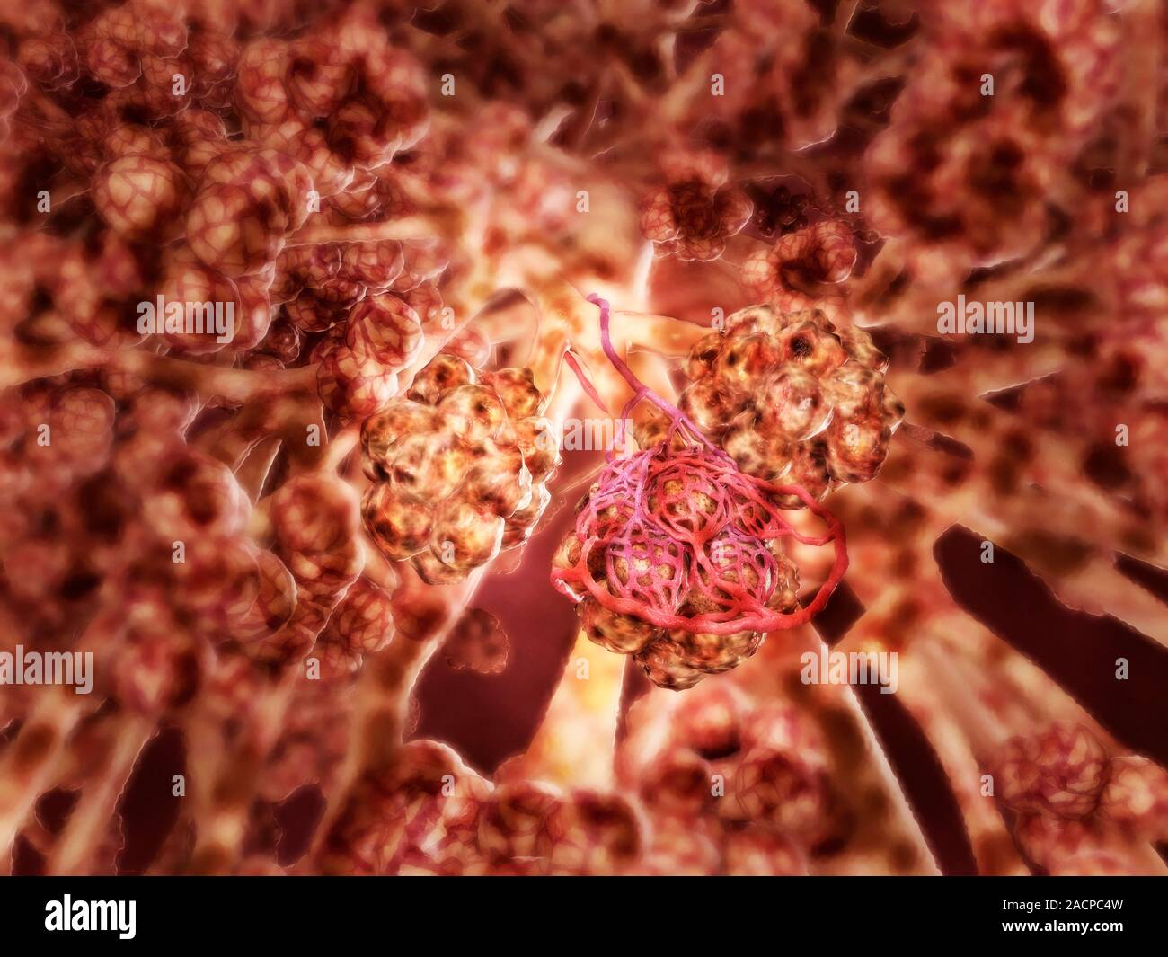 Diseased alveoli in the lung. Computer artwork showing diseased alveoli ...