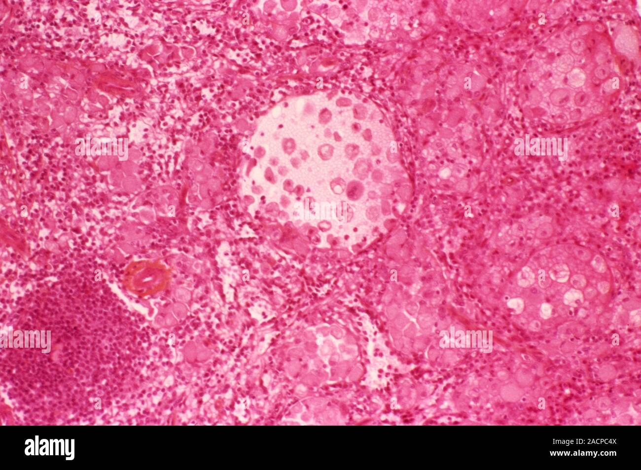 Gaucher's disease. Light micrograph of a section through the spleen of ...