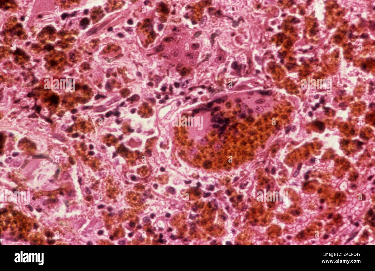 Excessive iron absorption. Light micrograph of a section through tissue ...
