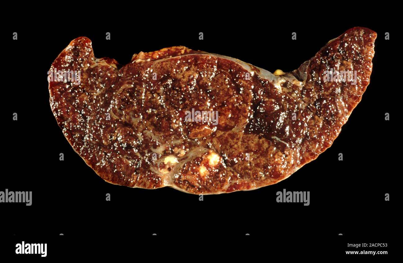 Angiosarcoma. Gross specimen of a sectioned spleen affected by ...