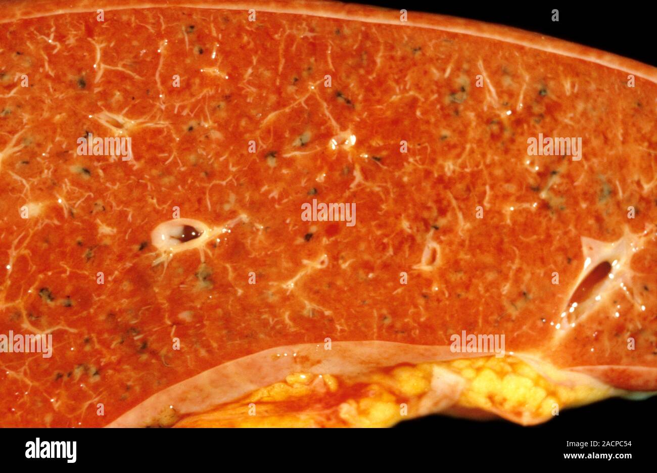 Spleen tuberculosis. Gross specimen of a sectioned spleen from a ...