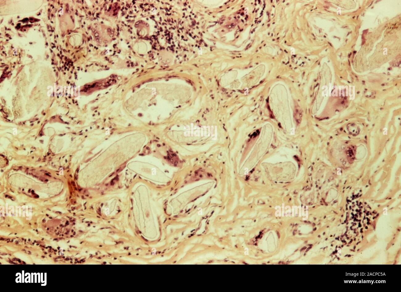 Dermoid Ovarian Cyst Light Micrograph Of A Section Through An Ovary With A Dermoid Or Teratoma