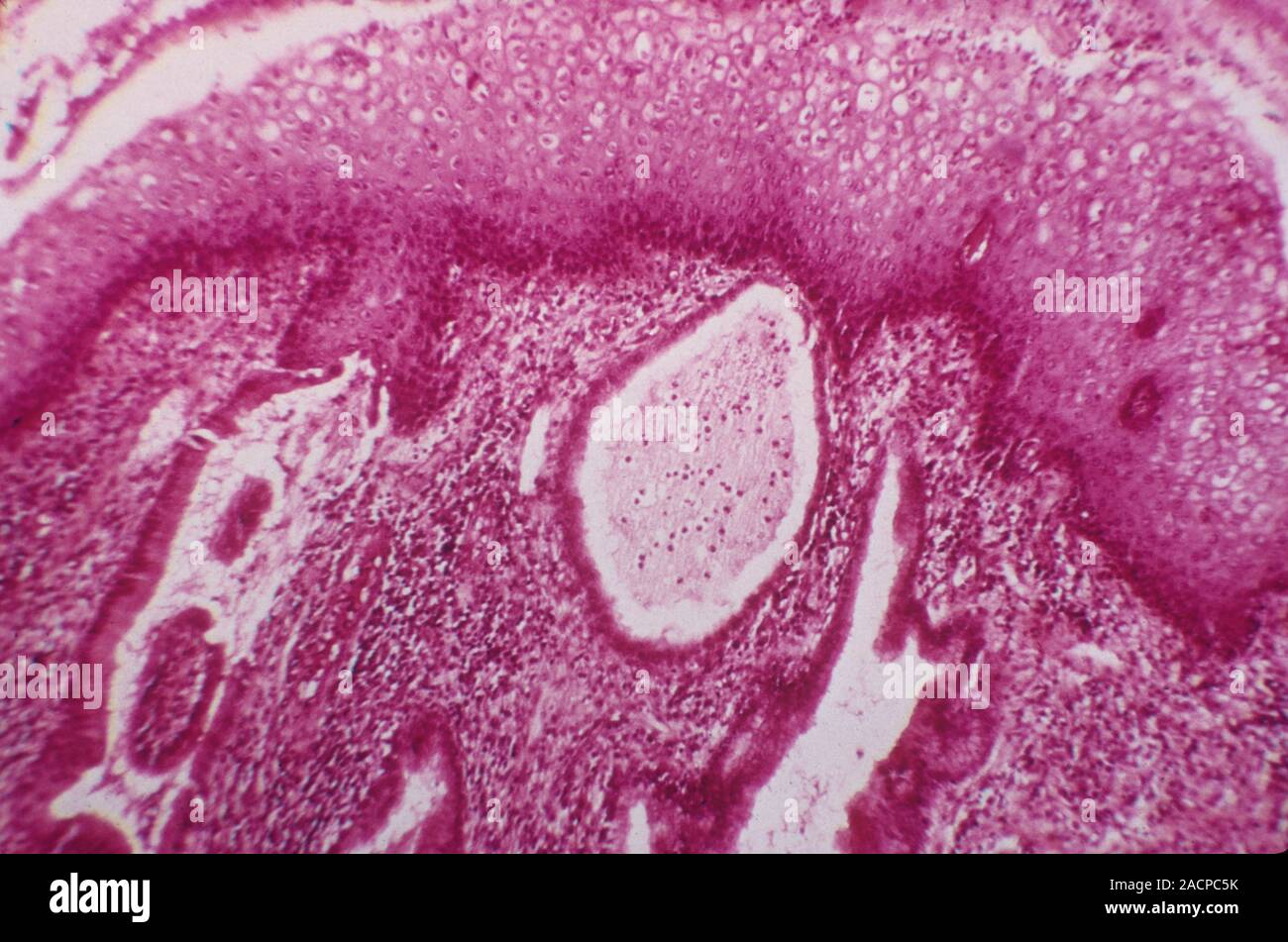 Cervical cyst. Light micrograph of a section through tissue from the ...