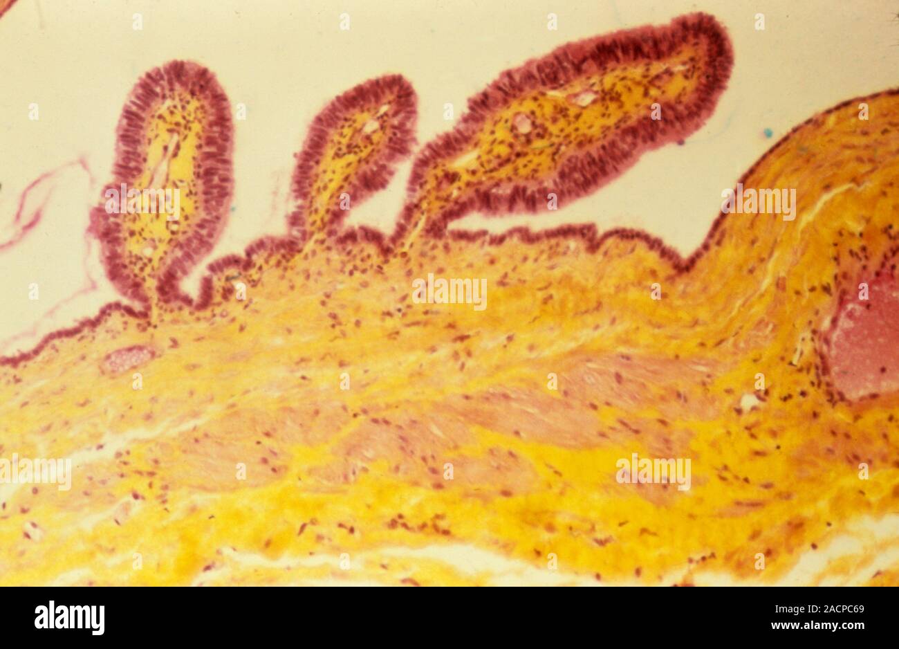 Paratubal cysts. Light micrograph of a section through a fallopian tube ...