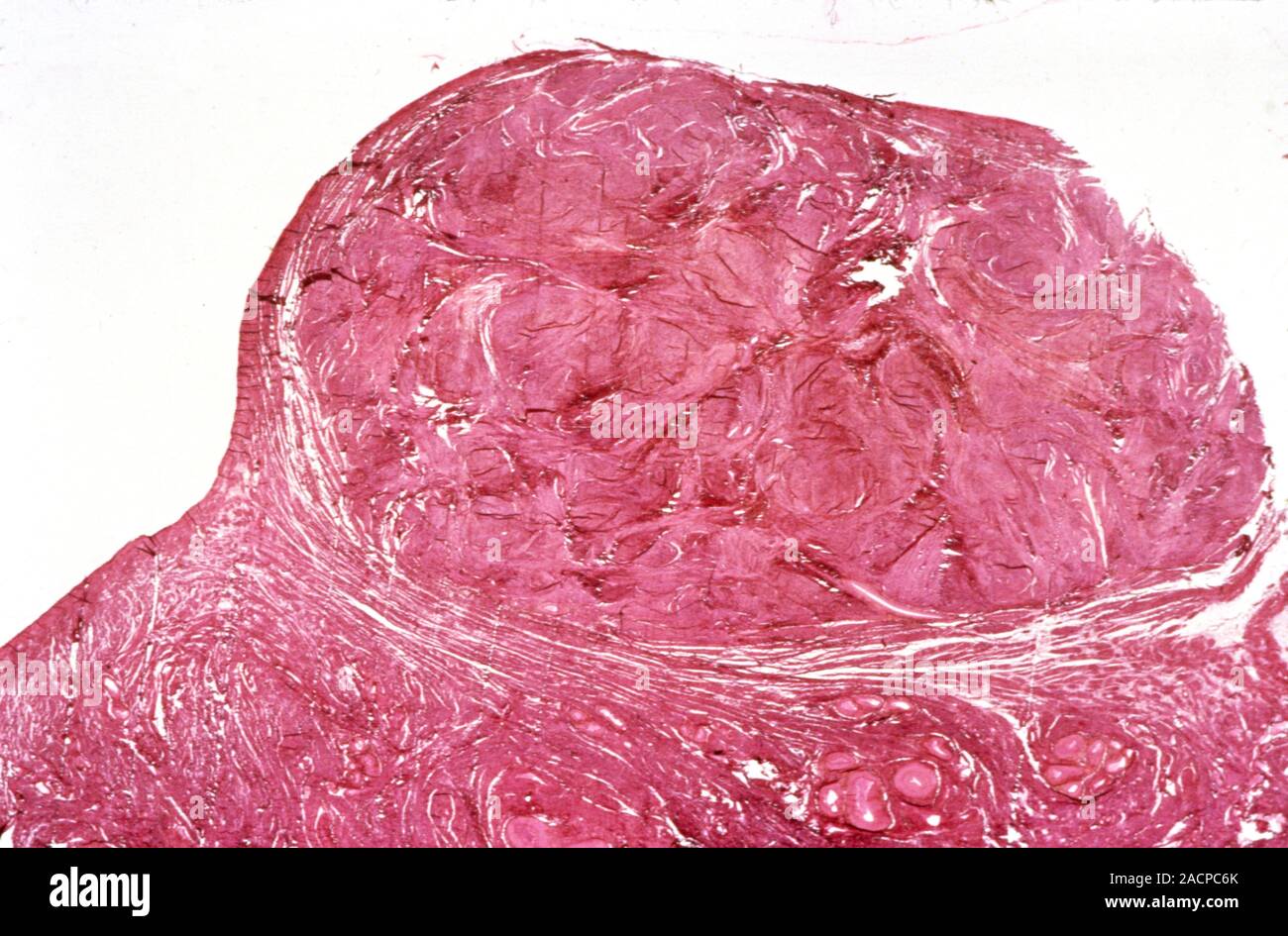 Uterine fibroid. Light micrograph of a section through a uterine ...
