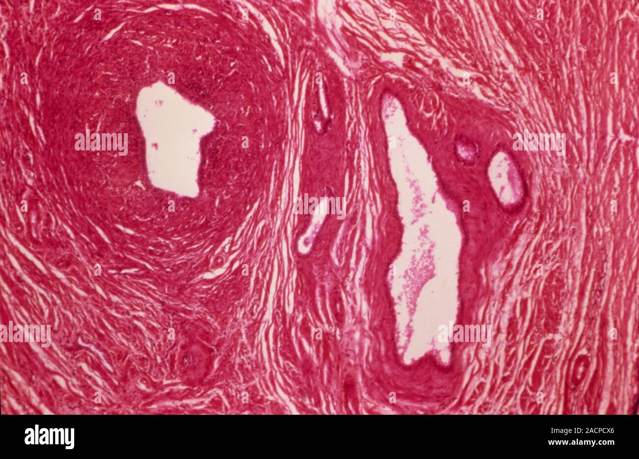 Inflamed fallopian tube. Light micrograph of a section through a ...