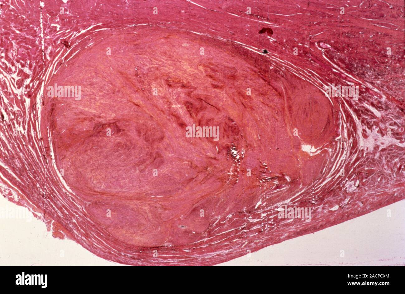 Uterine fibroid. Light micrograph of a section through a uterine ...