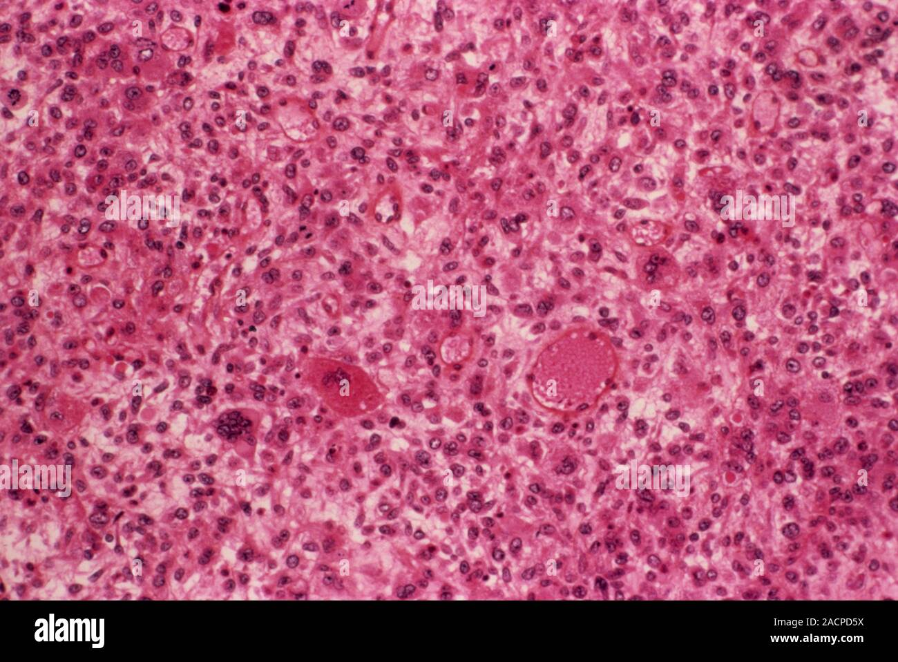 Cancer of the chorion. Light micrograph of a section through a sarcoma ...